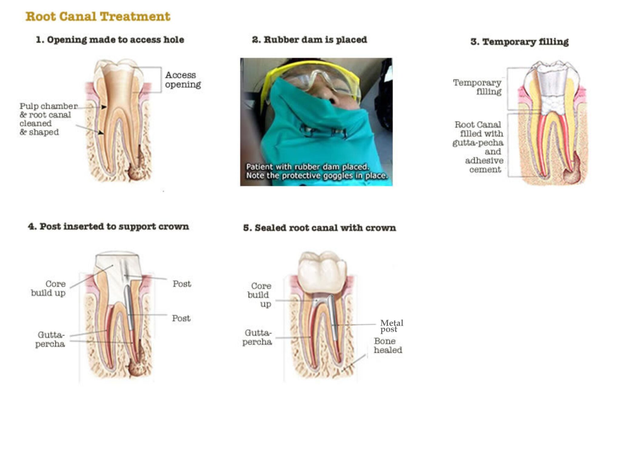 Endodontist & Root Canal Specialist in Singapore | Dr Seah SG