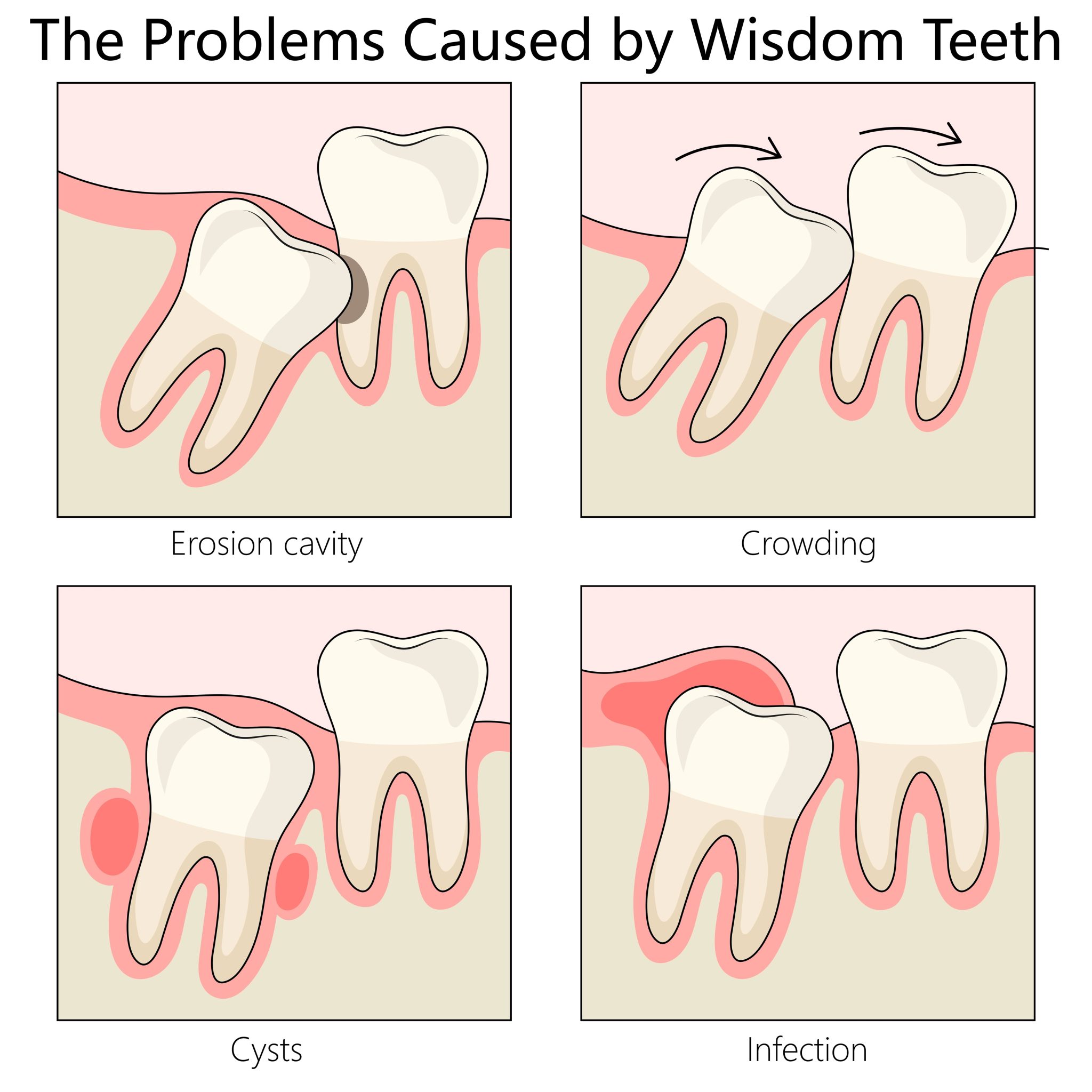 Wisdom Tooth Extraction & Removal in Singapore (Including Emergency Cases)