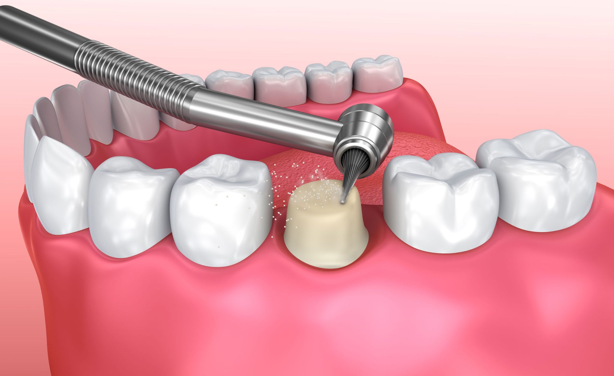 Dental Crowns and Teeth Crowning Services in Singapore